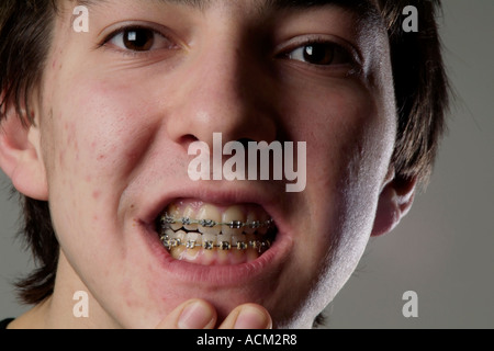Teenage boy parting his lips to show off the fixed orthodontic braces ...