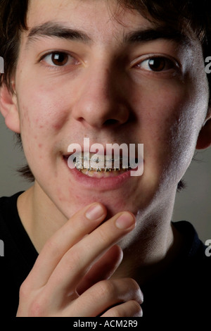 Teenage boy parting his lips to show off the fixed orthodontic braces ...