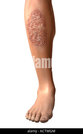 NECROSIS OF THE SKIN Stock Photo: 49182866 - Alamy