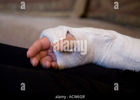 A BROKEN RIGHT ARM COLLES FRACTURE SET IN PLASTER FROM THE HAND TO JUST ...