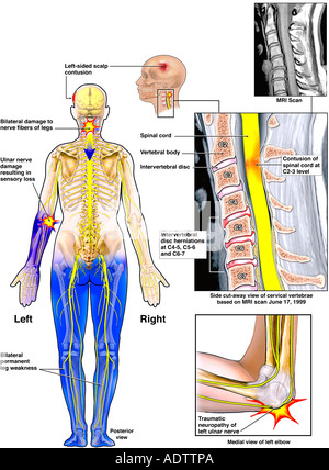 Neck Injuries - C3-4, C4-5 Disc Herniations and C5-7 Osteophytes Stock ...