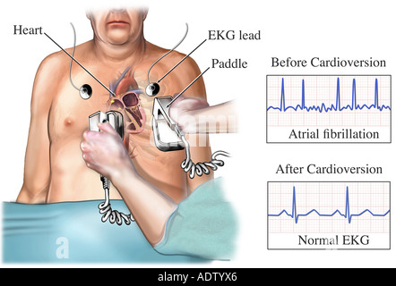 Cardioversion, 2 of 2 Stock Photo - Alamy