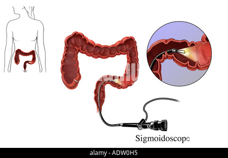 COLON, ENDOSCOPY EXAMINATION Stock Photo - Alamy