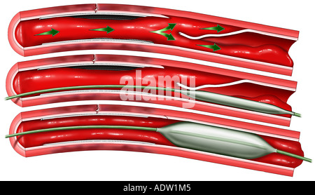 Medical - Cardiac catheterization balloon angioplasty procedure Stock ...