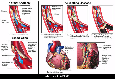 Occluded Coronary Artery Stock Photo - Alamy