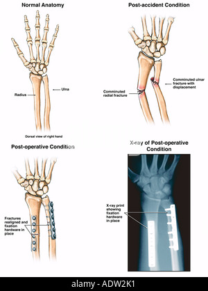 Fractured lower arm bones, X-ray. These fractures of the ulna and ...