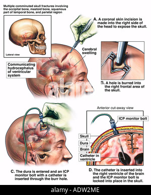 Brain meninges layers Stock Photo - Alamy