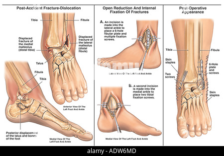 Open reduction and internal fixation of ankle-Ankle operation Stock ...