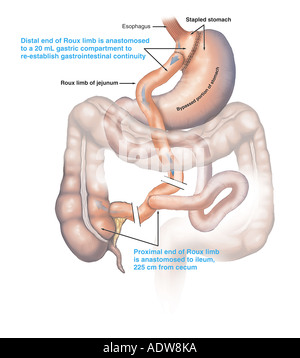 Abdominal Surgery Roux en Y Procedure to Correct Damaged Common Bile ...