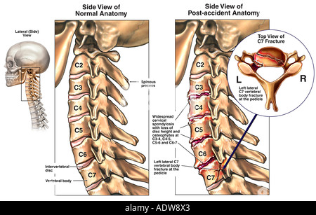Neck Injuries - C3-4, C4-5 Disc Herniations and C5-7 Osteophytes Stock ...