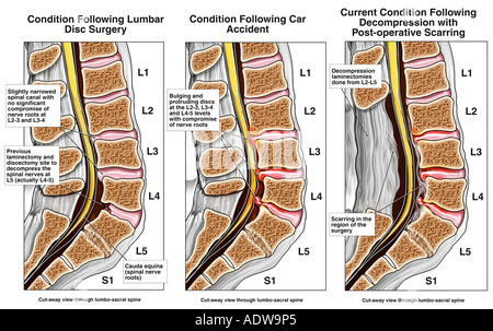 Lumbar Disc Herniation L4-5 with Surgical Laminectomy and Discectomy Stock Photo: 7710295 - Alamy
