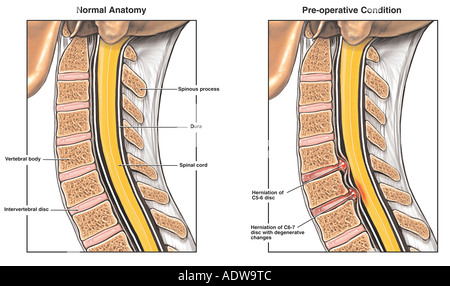 C6-7 Disc Herniation with Spinal Cord Compression Stock Photo: 7710010 ...