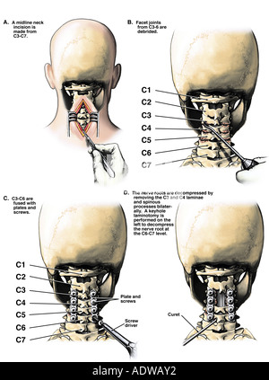 C3 4 C4 5 Cervical Spine Injuries with Surgical Discectomy and Fusion ...