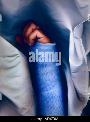 Broken Wrist, Arm with a Blue Fiberglass Cast on a white background ...