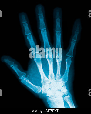 Conventional film based radiograph or xray of a human hand showing the ...