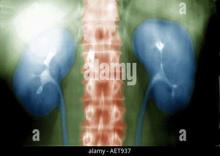 Intravenous pyelogram IVP of the kidneys showing how the intravenous ...