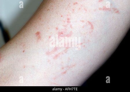 Eczema showing the Koebner Phenomenon Stock Photo - Alamy