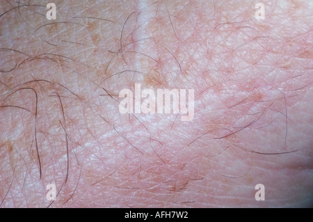 Vitiligo : Koebner phenomenon Stock Photo - Alamy