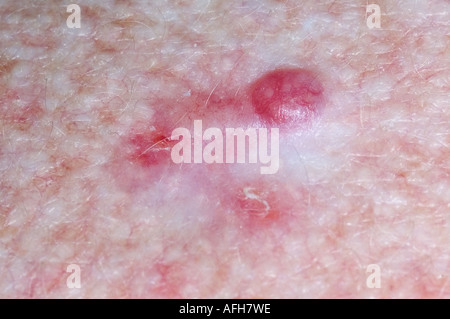 Recurrence Of Nodular BCC upper back Stock Photo - Alamy