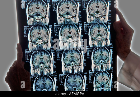 doctor examining x-rays of cerebral cortex cerebellum human brain Stock ...