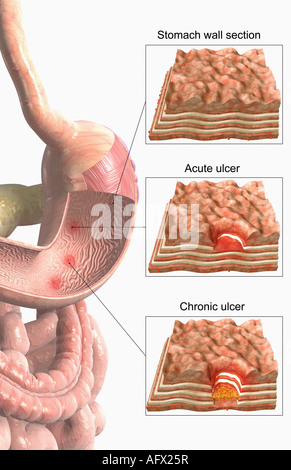 Gastric (stomach) ulcer, illustration. Gastric, or peptic, ulcers are ...