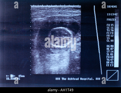 ULTRASOUND SCAN OF A 2 MONTHS OLD FOETUS Stock Photo - Alamy