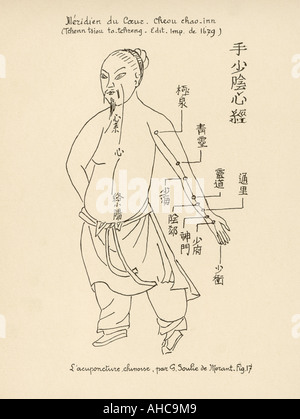 Acupuncture -- the Heart Stock Photo - Alamy