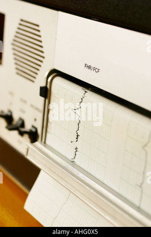 cardiotocograph, CTG, heart sound chart of an unborn child and a ...