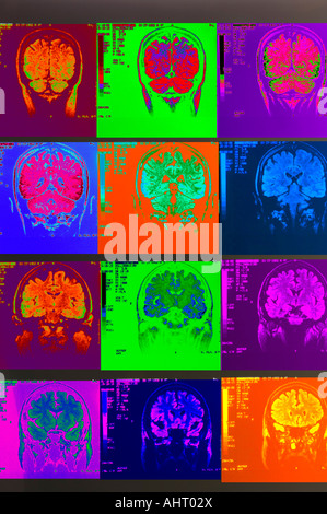 x-rays of cerebral cortex cerebellum human brain MRI Stock Photo - Alamy