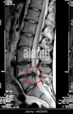 MRI scan clearly showing a slipped disc pressing on the spinal cord ...