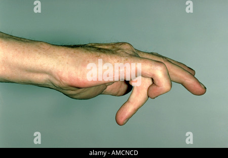Dupuytren's Contracture. A thickening of the palmar fascia into nodules ...