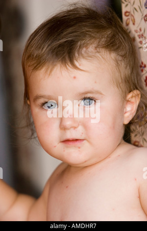 A portrait of the back of a toddler with the chicken pox dissease. The ...