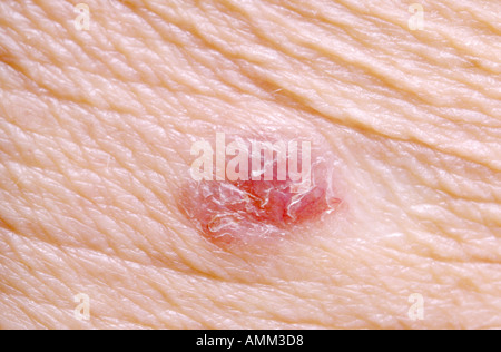 Basal cell carcinoma (BCC), or rodent ulcer, on a 52 year old man's ...