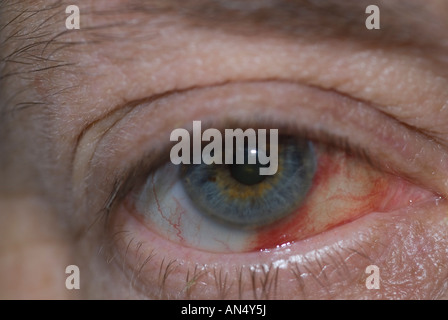Close-up of the red and inflamed eye in a 36 year old female patient ...