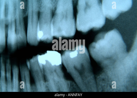 Dental X-ray image showing dental amalgam Stock Photo - Alamy