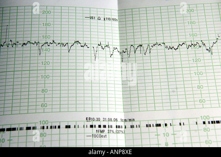 ECG OF A BABY Stock Photo - Alamy