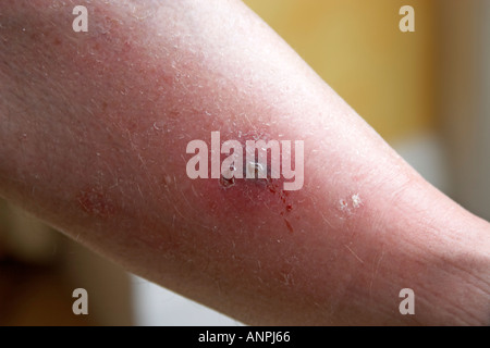 Septic leg wound and scab on shin of middle aged man Stock Photo - Alamy