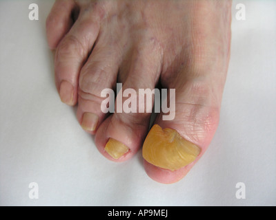 elderly woman's foot showing toes with onychogryphosis a thickening of ...