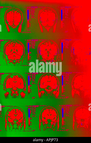 colored x-rays of cerebral cortex cerebellum human brain MRI Stock ...