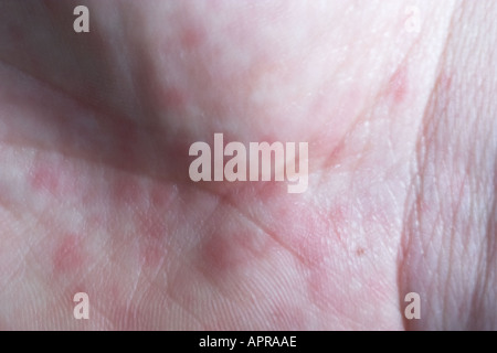 Close up of urticaria or allergy rash Stock Photo, Royalty Free Image ...