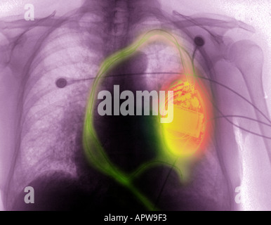 chest xray showing cardiac pacer defibrillator Stock Photo - Alamy