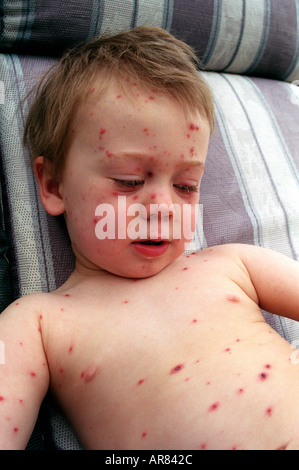Young child with bad case of Chickenpox Stock Photo - Alamy