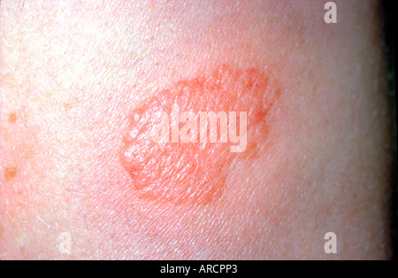 A reaction to the Mantoux PPD skin test is measured with a clinical ...