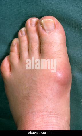 The swollen foot of a patient with gout, also known as uric acid ...