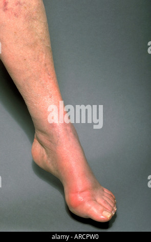 The swollen foot of a patient with gout, also known as uric acid ...