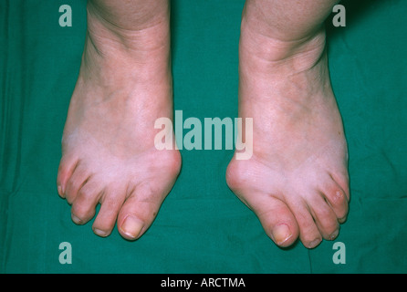 Bunions. Foot of a patient with bunions (hallux valgus, centre left ...