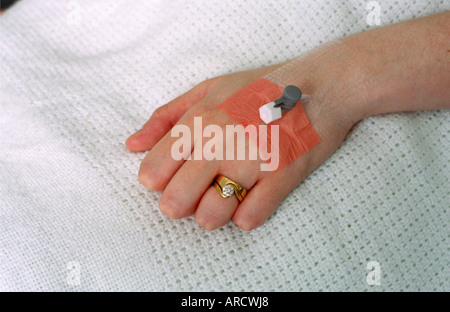 Intravenous cannula in situ Stock Photo - Alamy