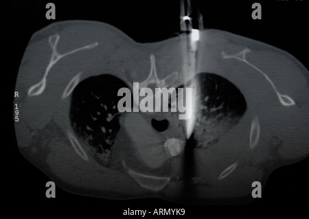 Pneumothorax, CT scan Stock Photo - Alamy