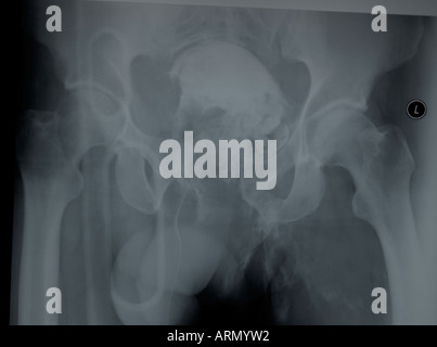 x-ray of gross open book fracture of male pelvis Stock Photo - Alamy