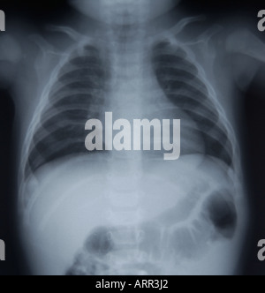 frontal view of pediatric chest x-ray Stock Photo: 9206122 - Alamy